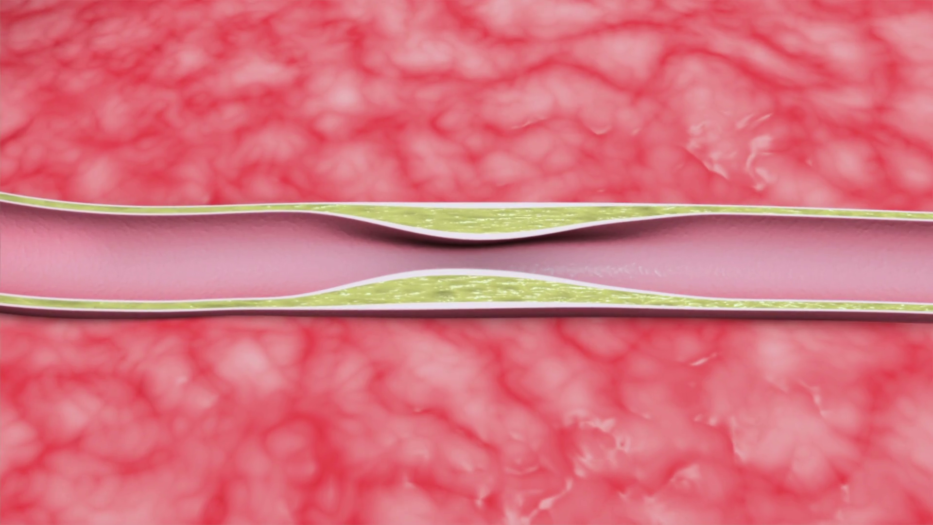 Artery Cross-section Showing Stent Deployment Stock Motion Graphics SBV ...