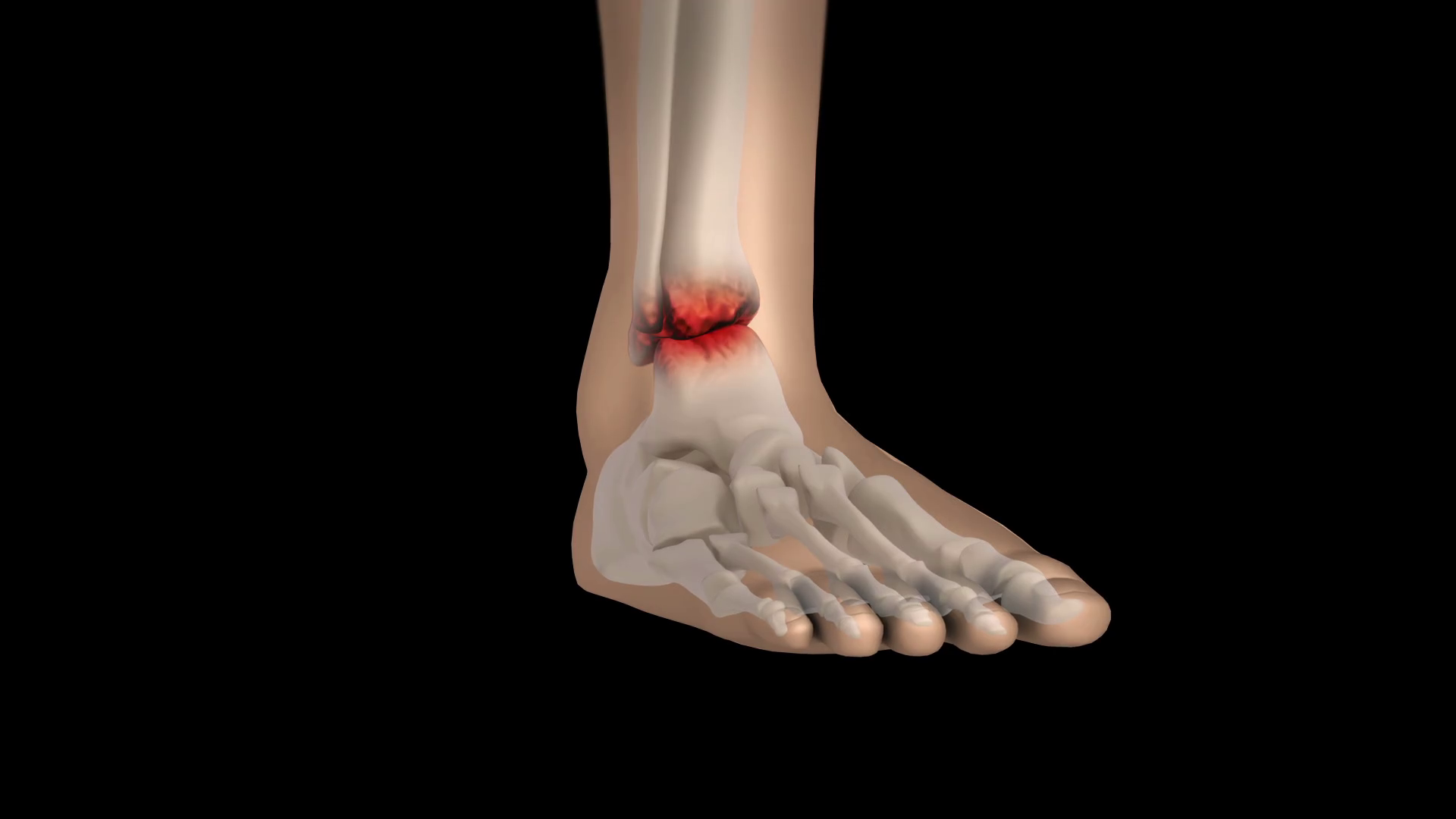Biomedical Animation Showing Ankle Fusion Stock Motion Graphics SBV ...