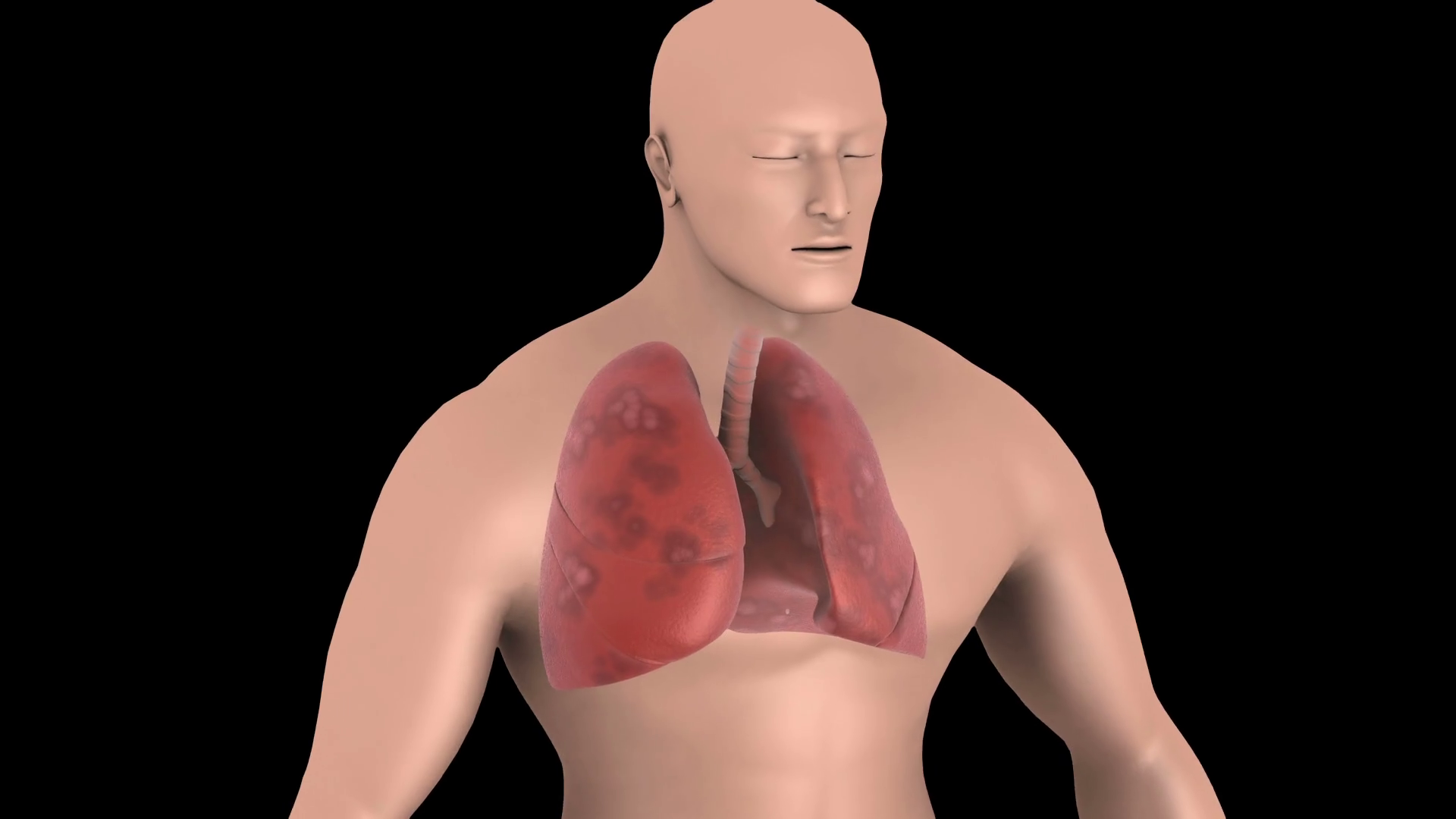 Biomedical Animation Of Emphysema In Human Stock Motion Graphics SBV ...
