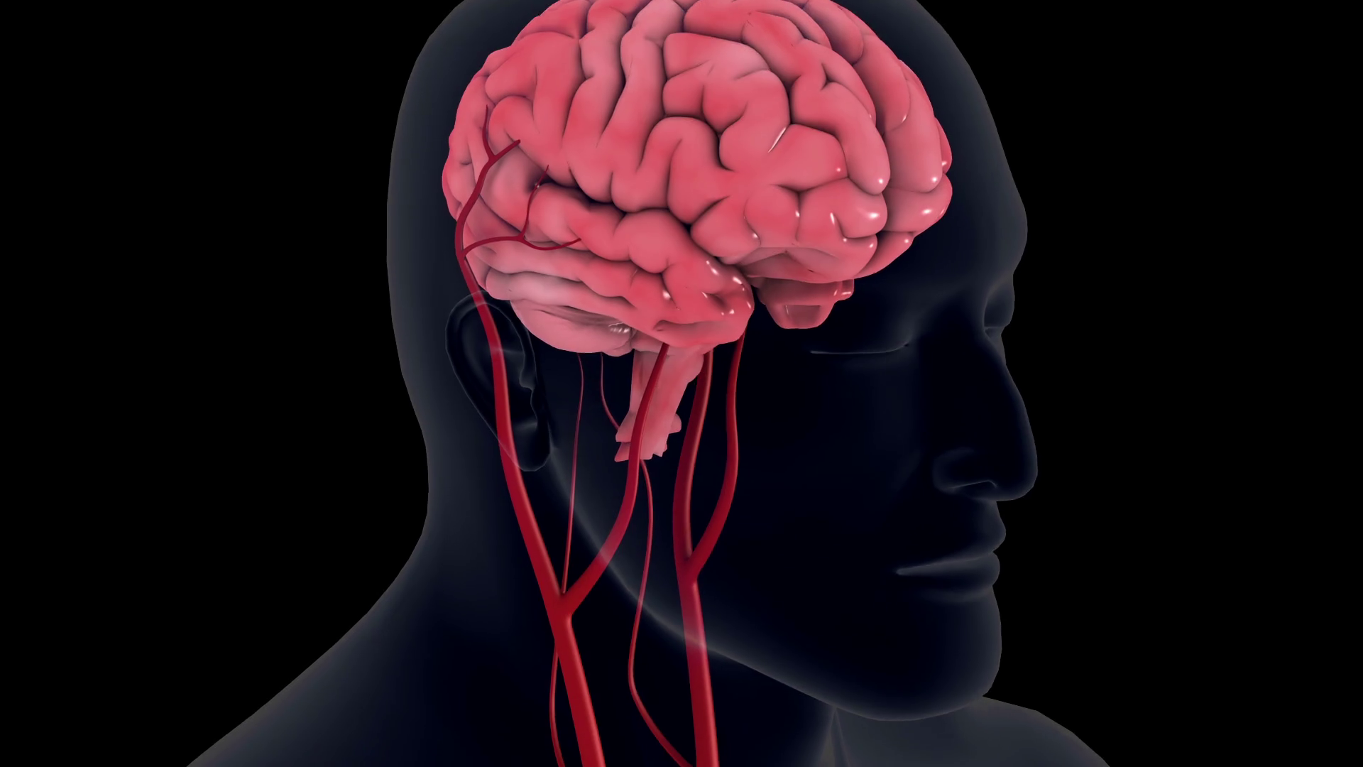 Biomedical Animation Of Ischemic Stroke In Stock Motion Graphics SBV ...