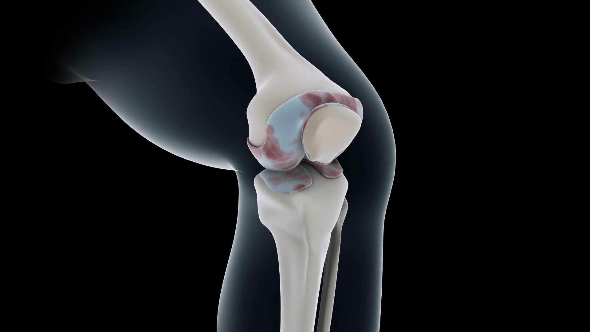 Biomedical Animation Of Knee Replacement Stock Motion Graphics SBV ...