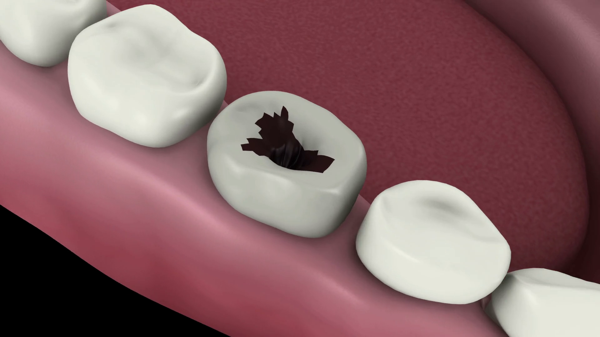 Biomedical Animation Of Root Canal Treatment Stock Motion Graphics SBV ...