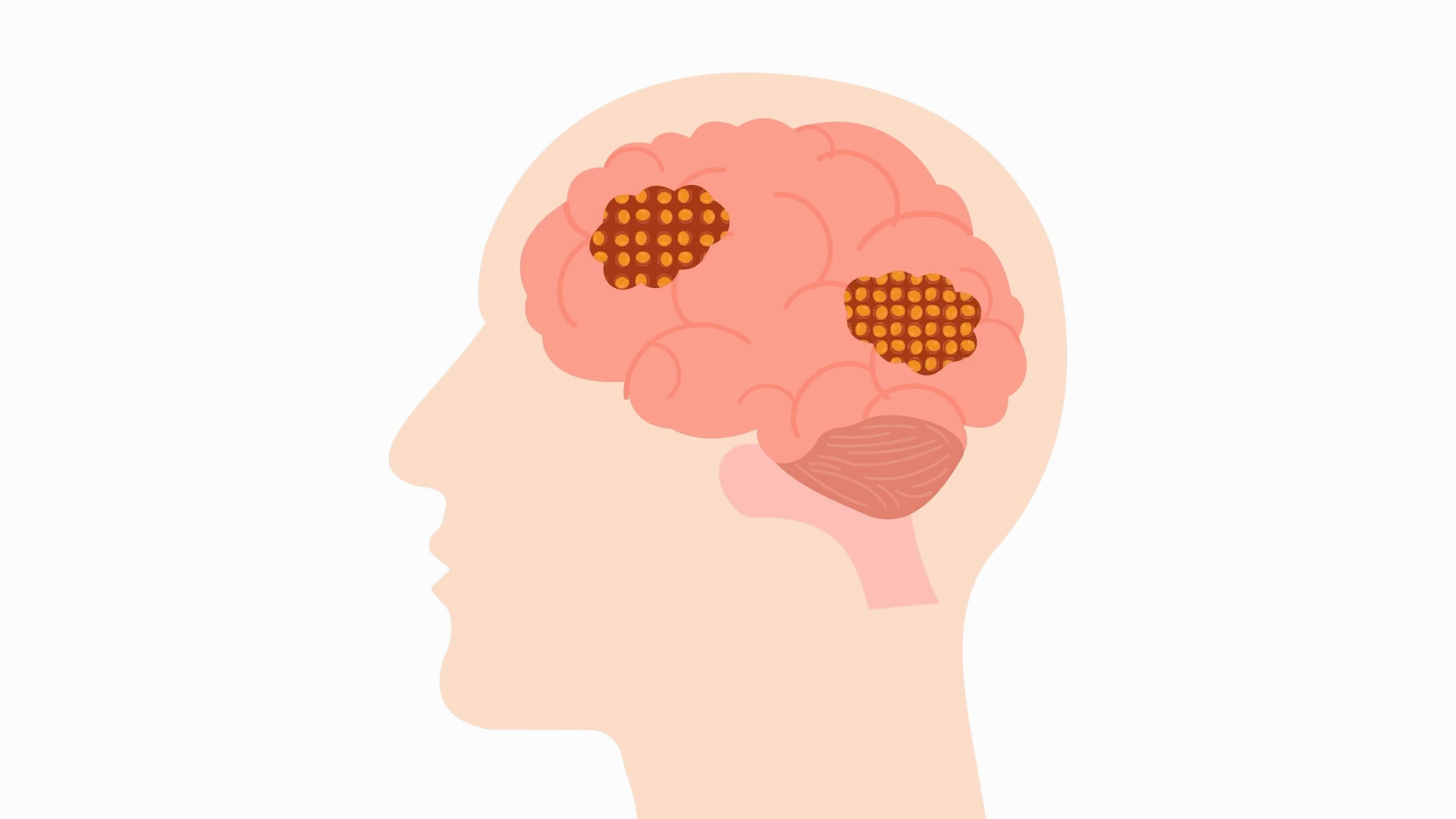 Human Brain Tumor Cancer Disease Medical Stock Motion Graphics SBV ...