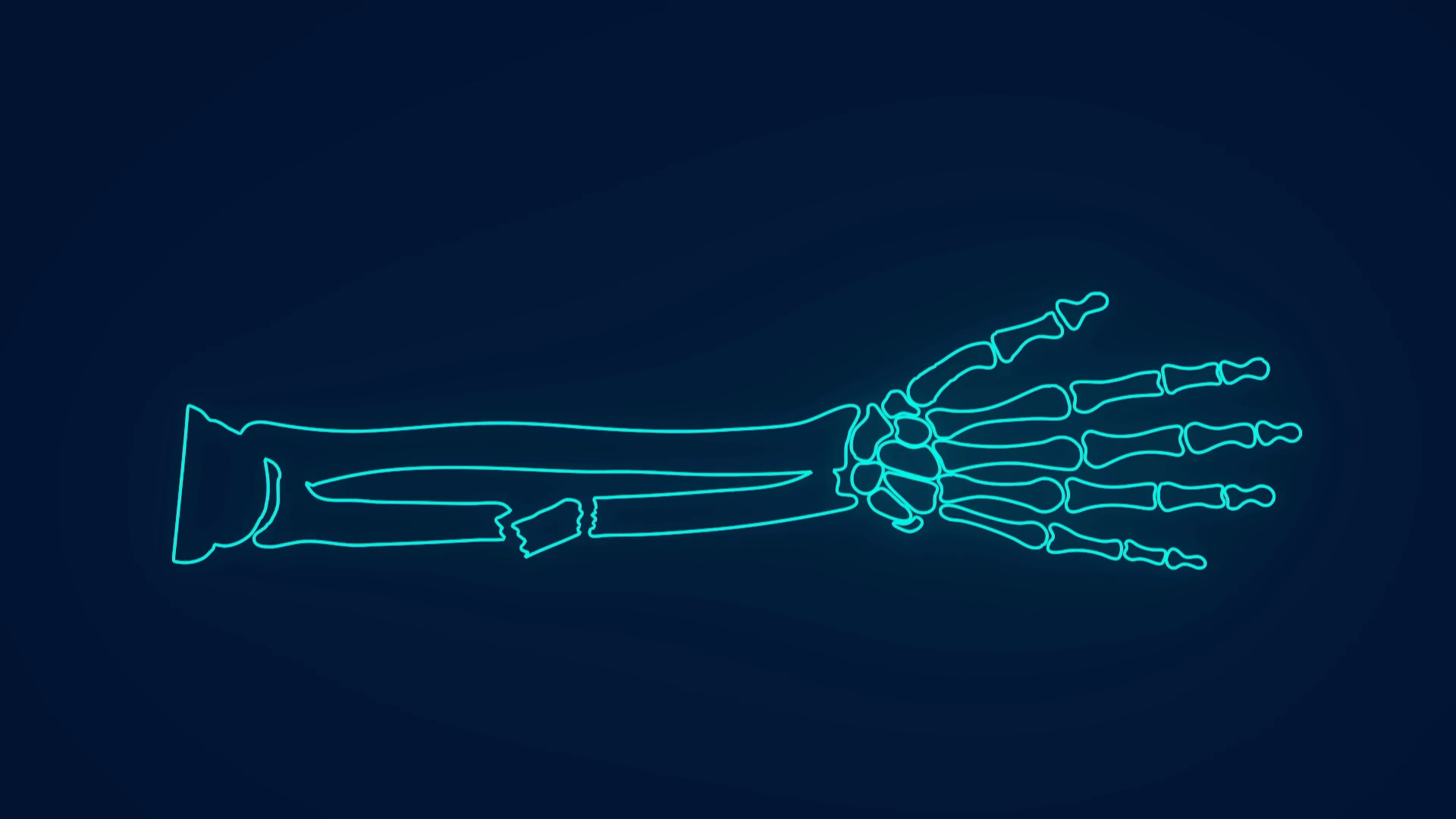 Fractured Hand Bones Medical X Ray Animation Stock Motion Graphics SBV ...