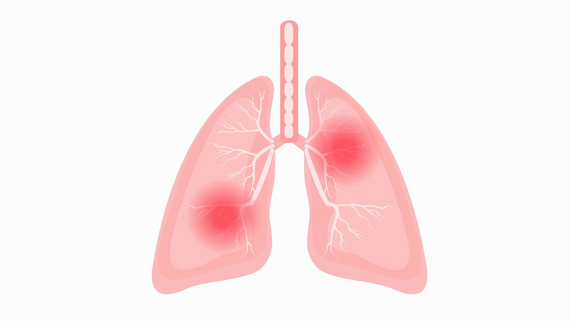 Pain In Lungs Bronchitis Medical Science Stock Motion Graphics SBV ...