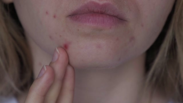 Skin Infection Stock Footage: Royalty-Free Video Clips - Storyblocks