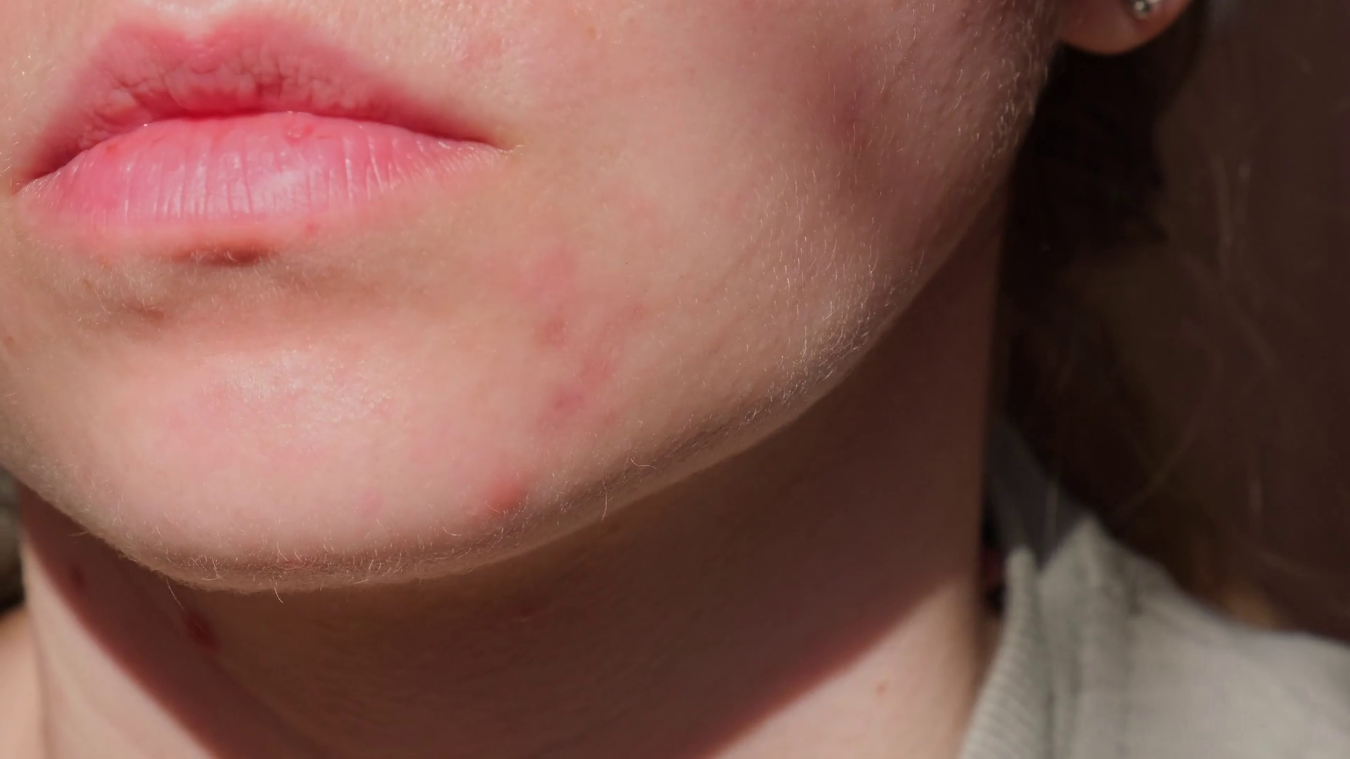 Woman Touching Acne On Face Skin Health Stock Footage SBV-348413782 ...