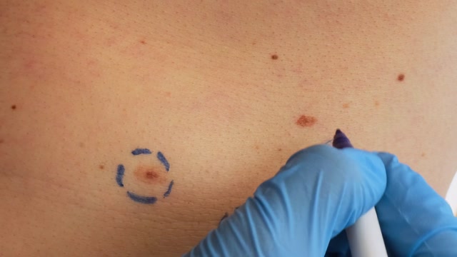 C Section Scar Stock Footage: Royalty-Free Video Clips - Storyblocks