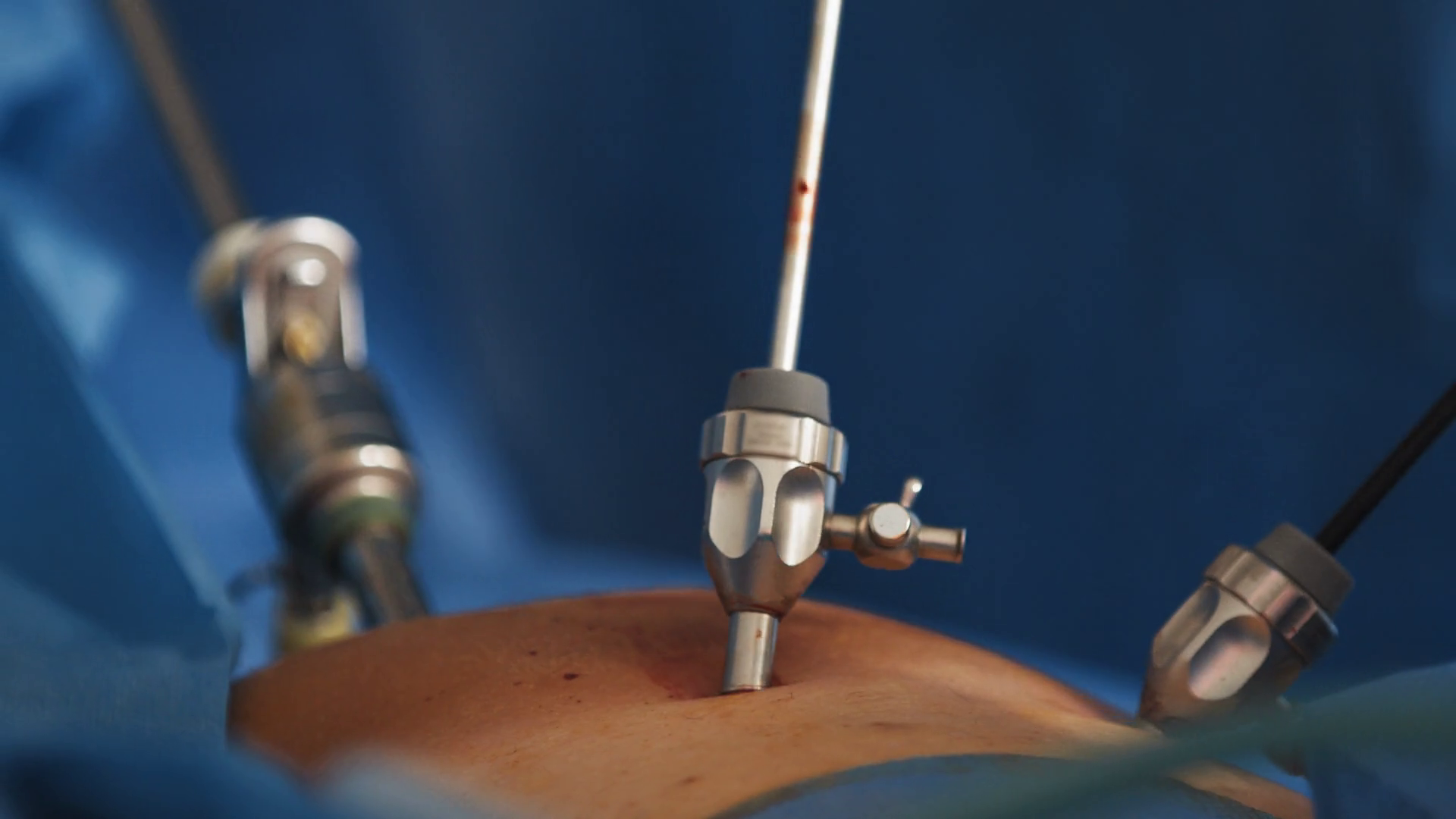 Endoscopy Close-up Surgeons' Hands With Help Stock Footage SBV ...