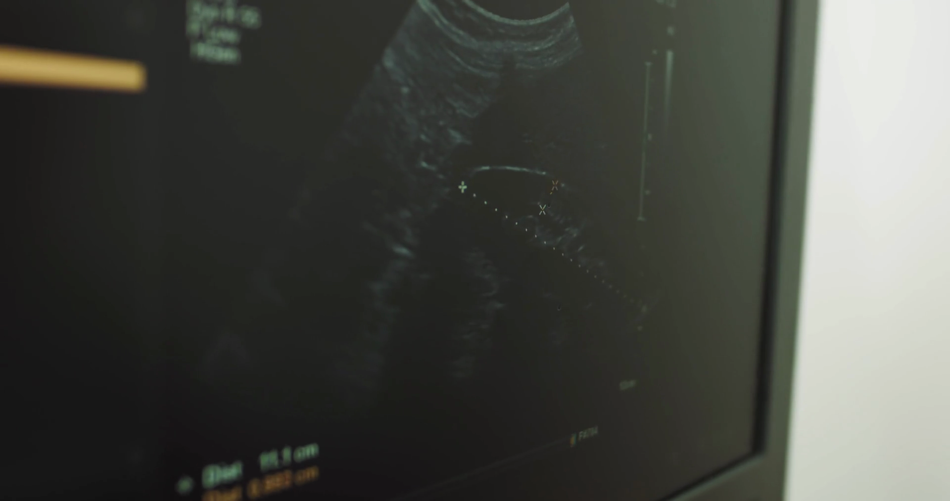 Sonography Screen Of Ultrasound Machine Stock Footage SBV-348525521 ...
