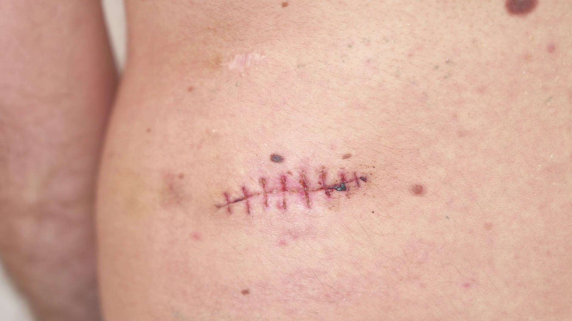 Close-up Of Stitched Wound On Skin In Early Stock Footage SBV-352494566 ...
