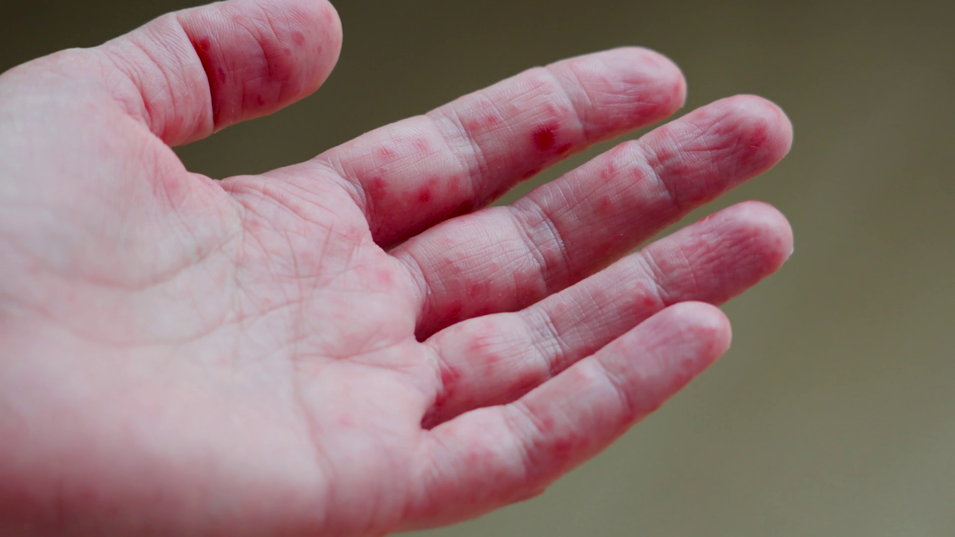 Understanding Hand Rashes Conditions Like Stock Footage SBV-352280975 ...