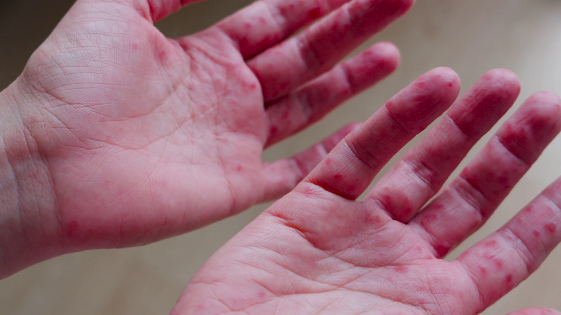 Understanding Hand Rashes Skin Conditions In Stock Footage SBV ...