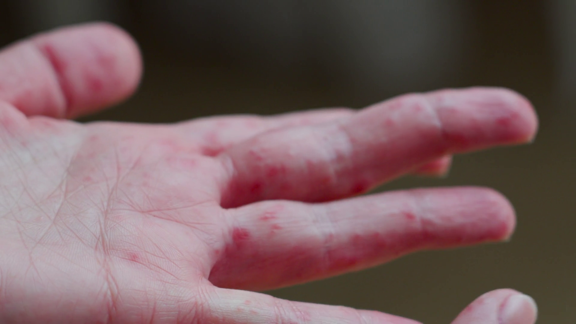 Rash On Hand Reveals Potential Causes Stock Footage SBV-352281007 ...