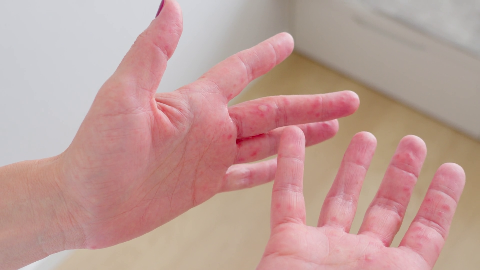 Understanding Hand Rashes In Children Causes Stock Footage SBV ...