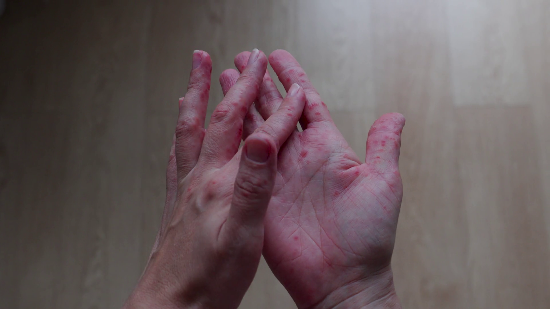 Exploring Causes Symptoms Of Hand Rashes In Stock Footage SBV-352280958 ...