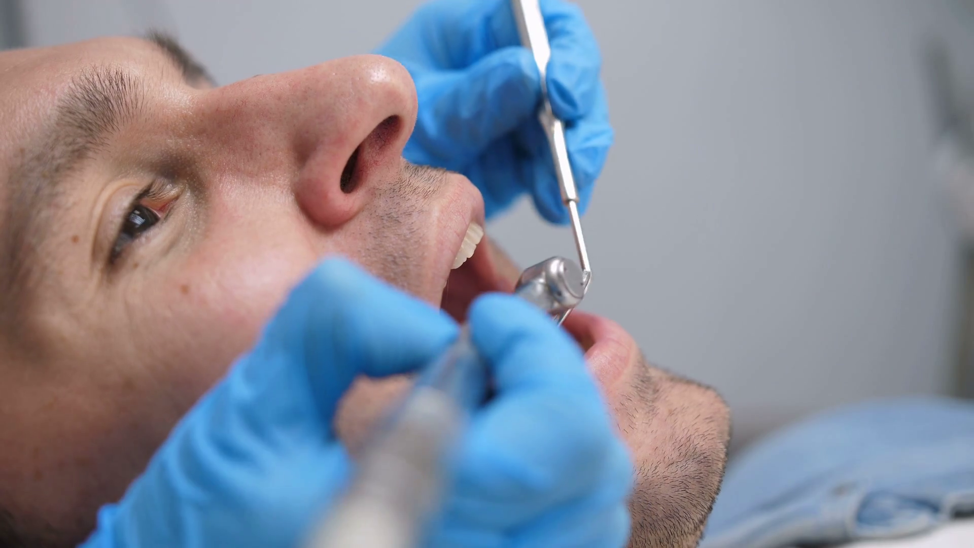 Dental Treatment: Close-up Of Male Patient Stock Footage SBV-323432762 ...