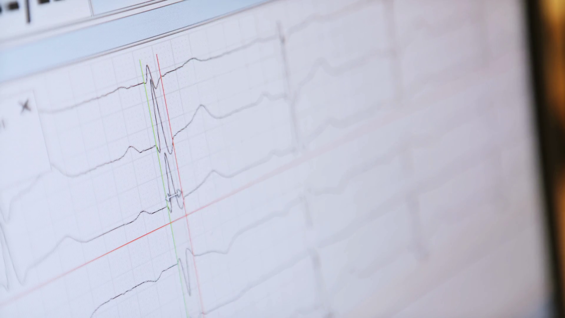 Close Up View Of Ecg Waves On Monitor In Stock Footage SBV-347633395 ...