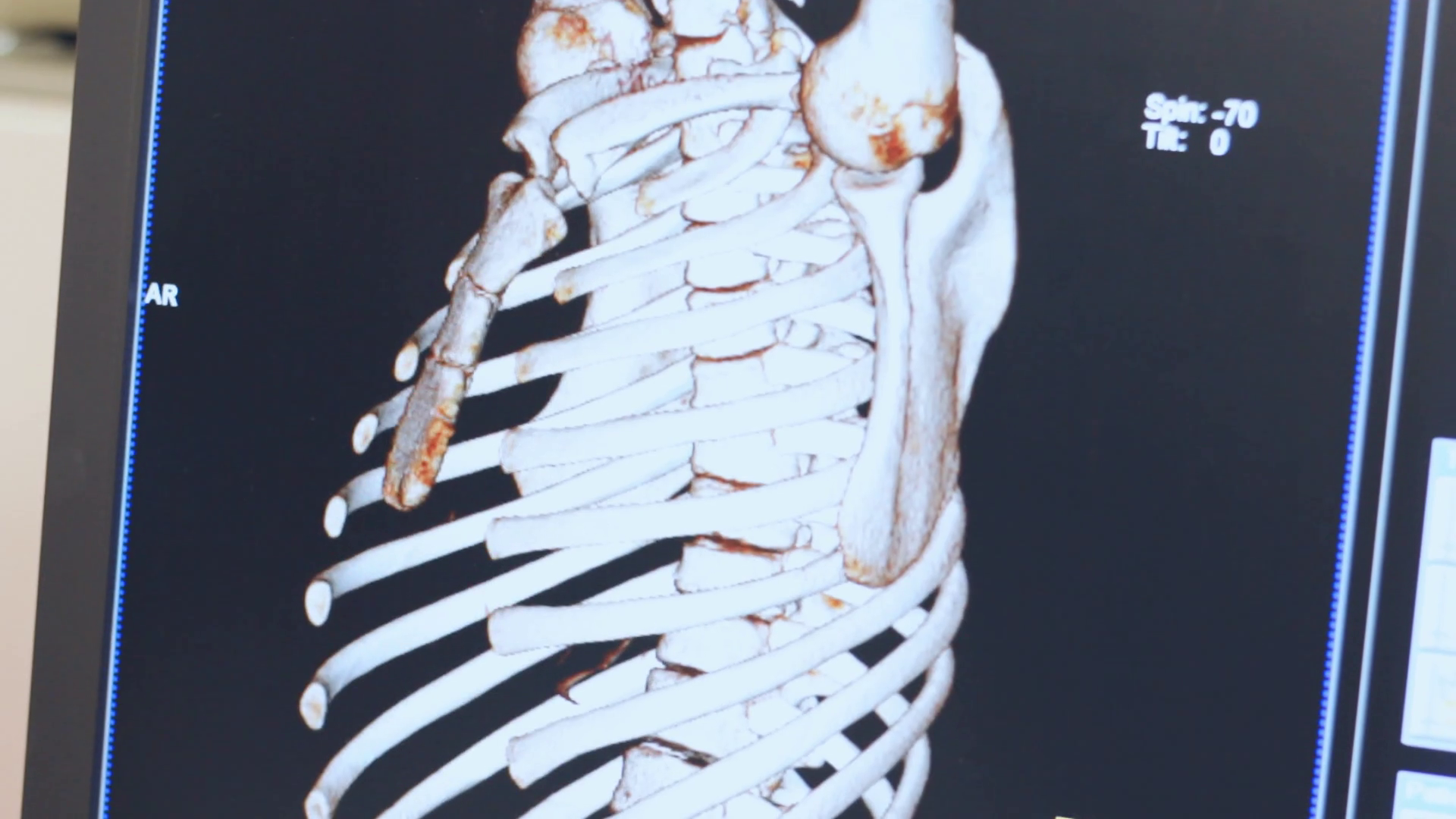 Magnetic Resonance Imaging Of Human Skeleton Stock Footage SBV ...