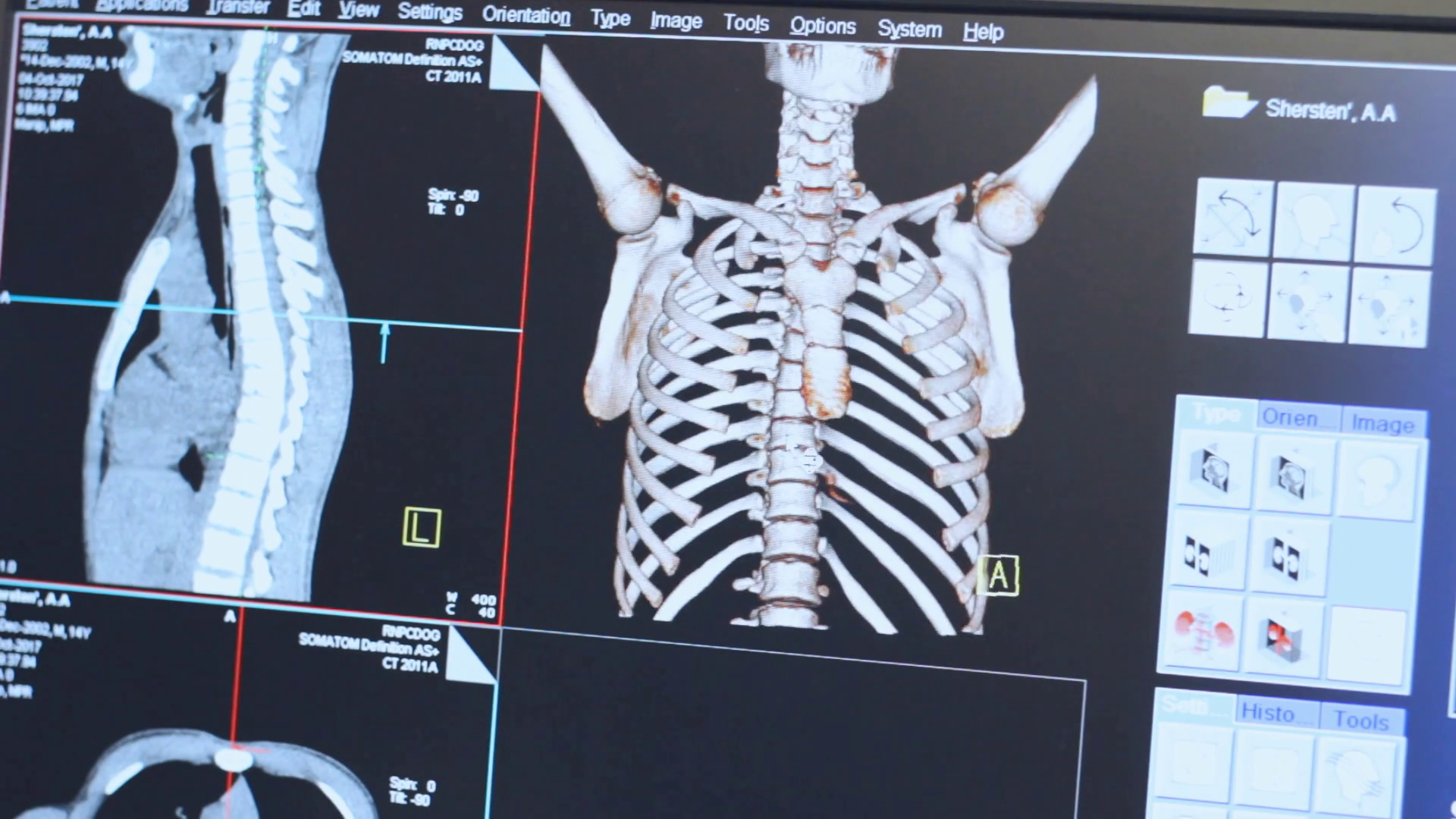 Tomography Scan Of Human Rib Cage On Monitor Stock Footage Sbv 327544916 Storyblocks