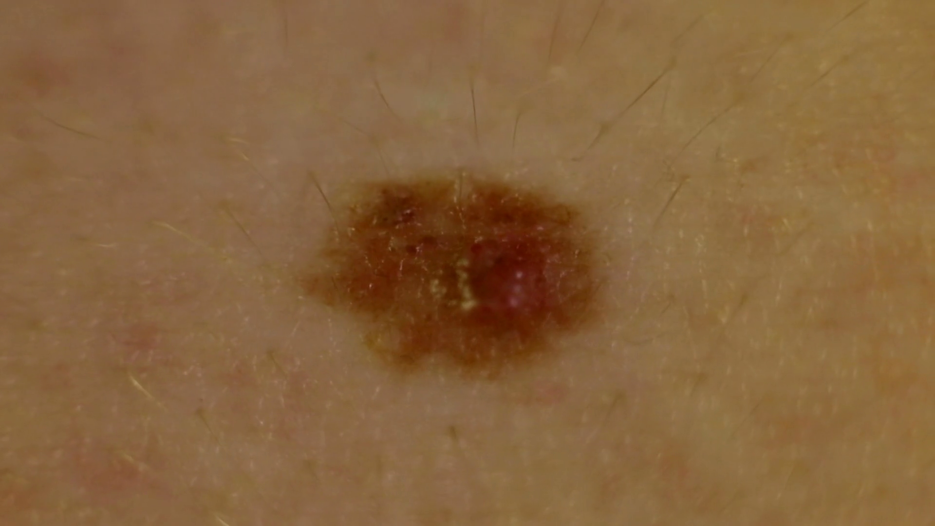Little skin mole macro shot Stock Video Footage 00:12 SBV-346963053 ...