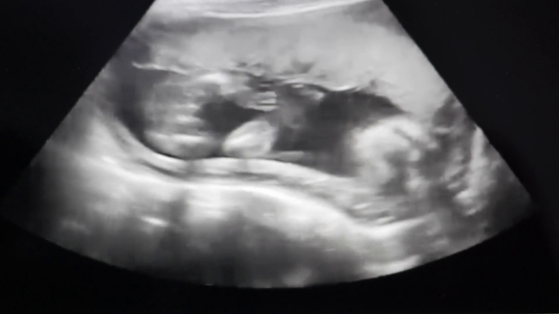 Ultrasound: Baby's Arm In Mother's Womb Stock Footage SBV-312062581 ...