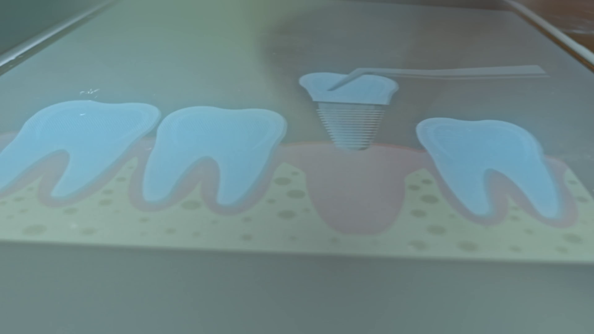 Presentation Of Dental Implant Tooth Stock Footage SBV-351907438 ...