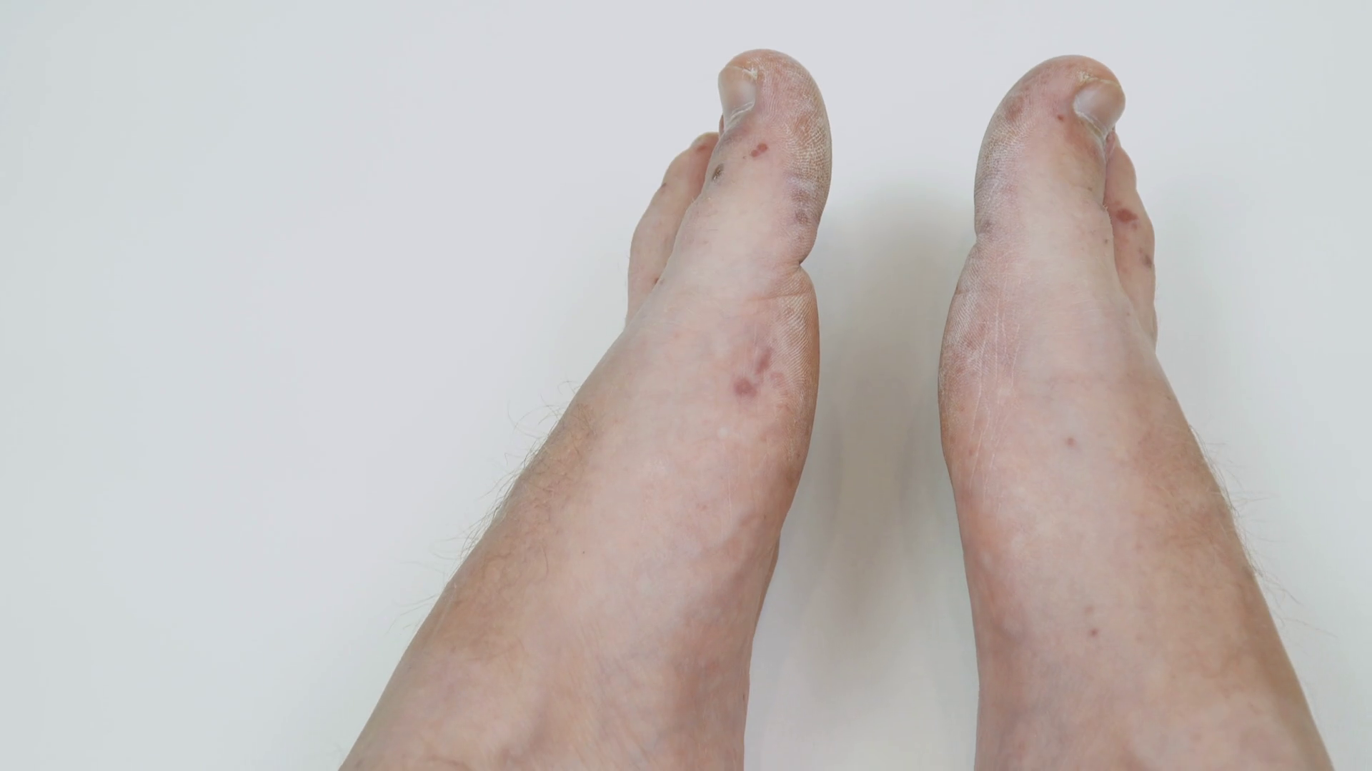Painful Rash Red Blisters On Man's Leg Human Stock Footage SBV ...
