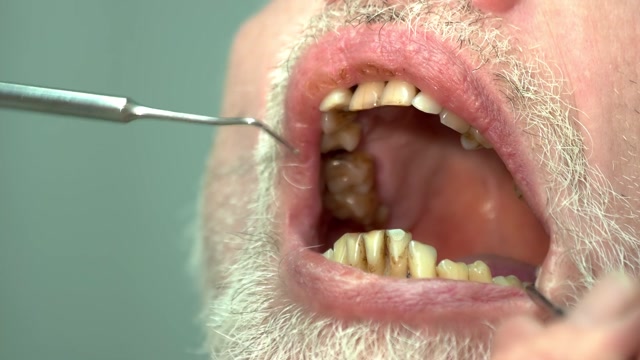 Dental Calculus Stock Footage: Royalty-Free Video Clips - Storyblocks